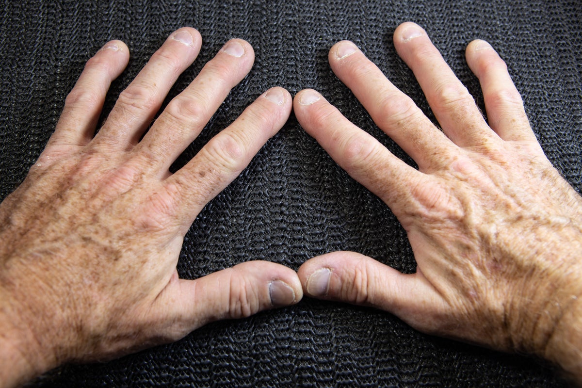 What is the Difference Between Rheumatoid Arthritis and Osteoarthritis