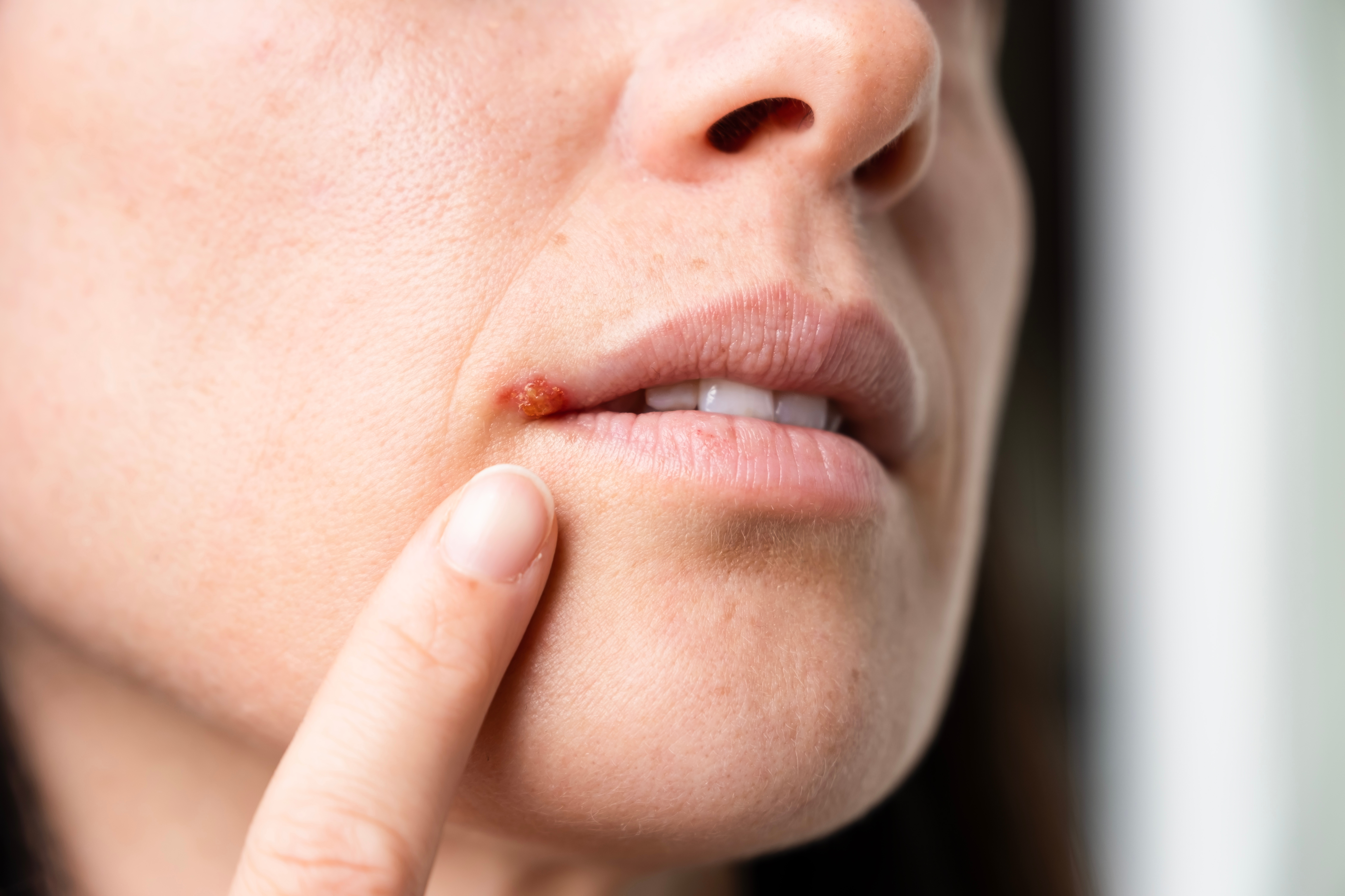 Lip Tumor Symptoms