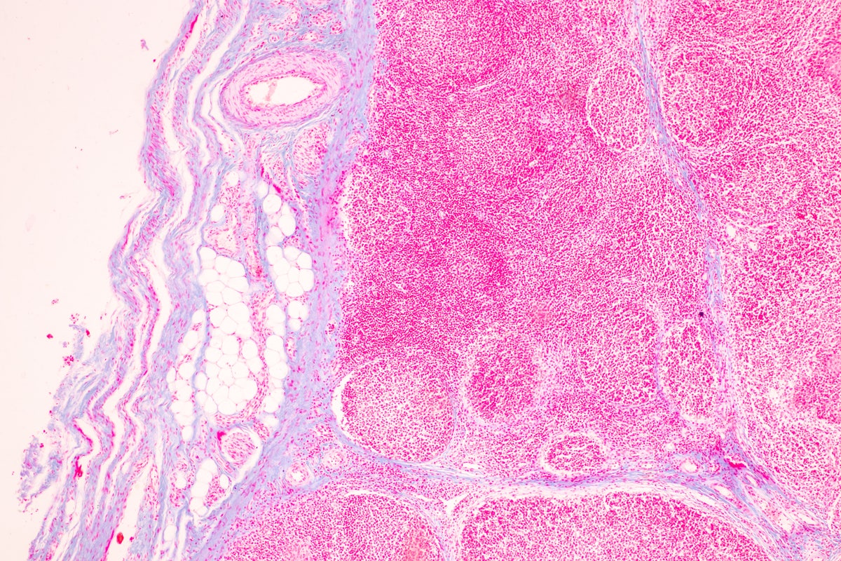 Diagnosing Wilms Tumor