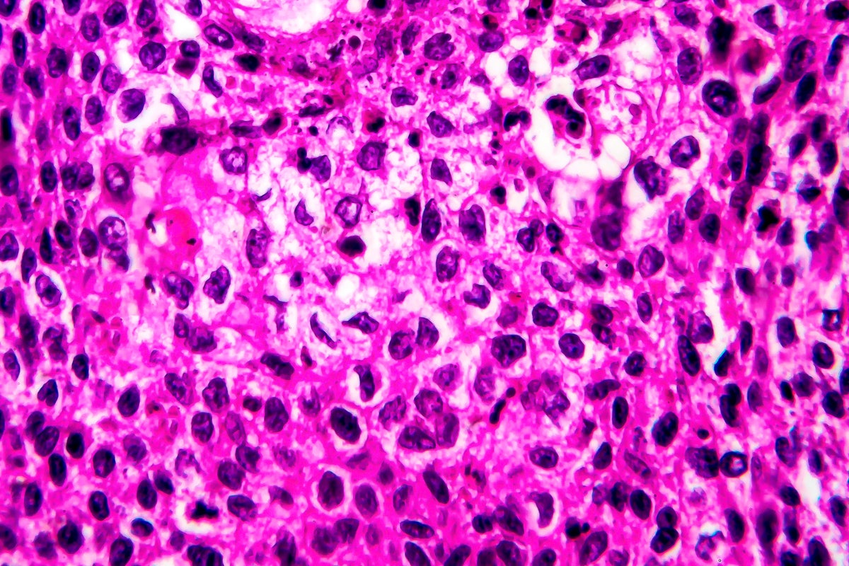 About Non-Hodgkin Lymphoma Stage 2