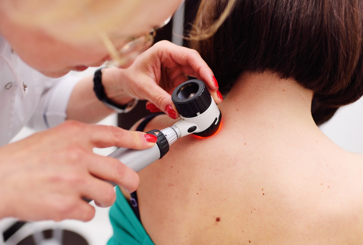 Diagnosing Skin Cancer