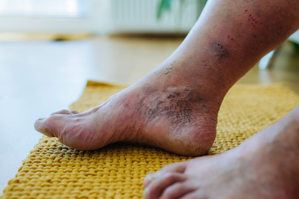 Diagnosing Superficial Thrombophlebitis