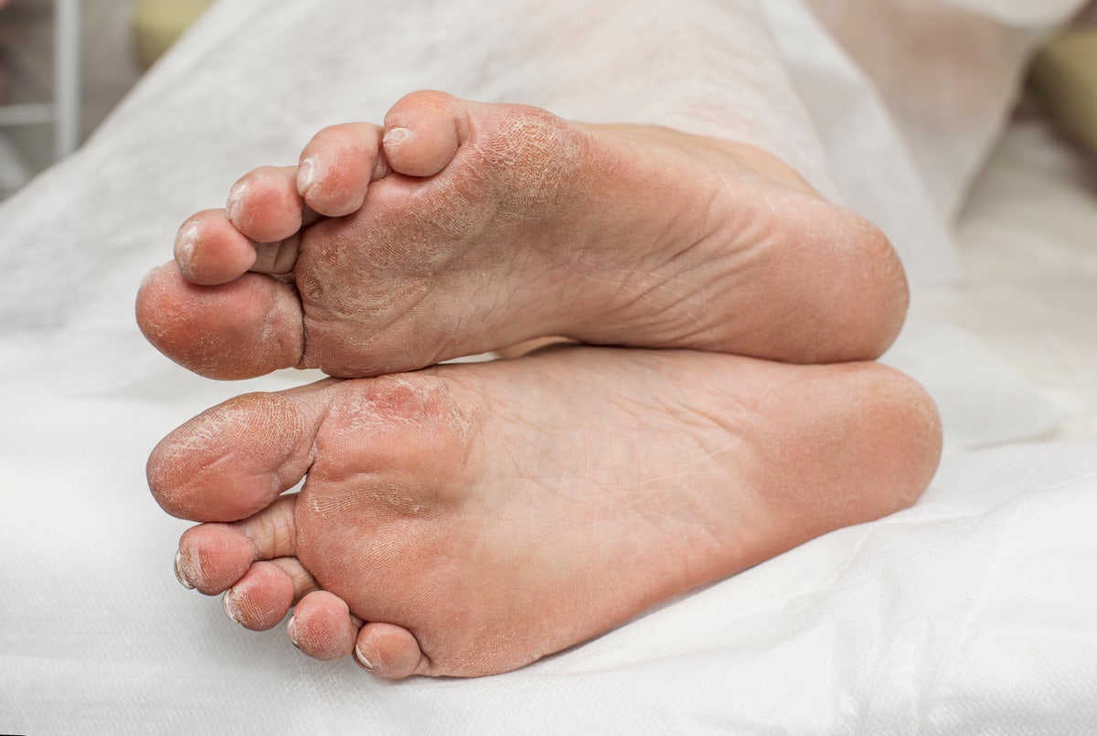 Diabetes and Dry Feet