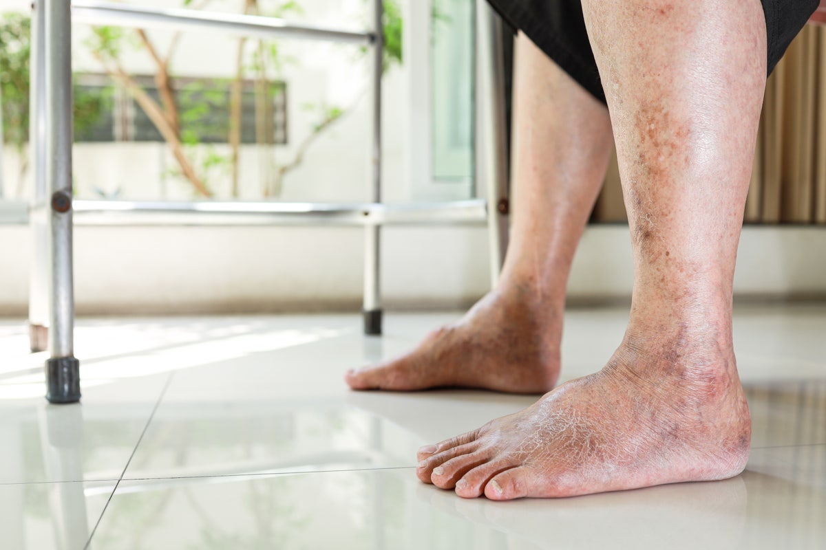 Diabetes and Edema