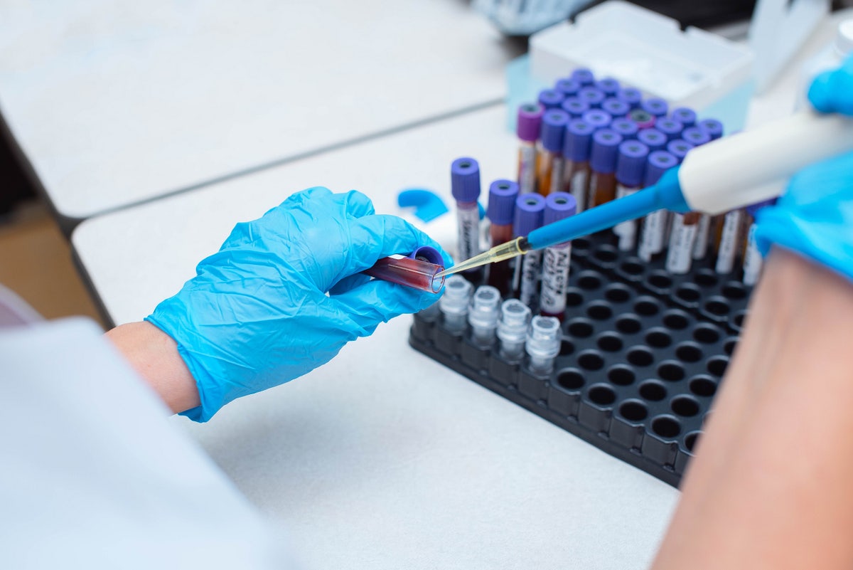 Diagnosing Hepatitis B