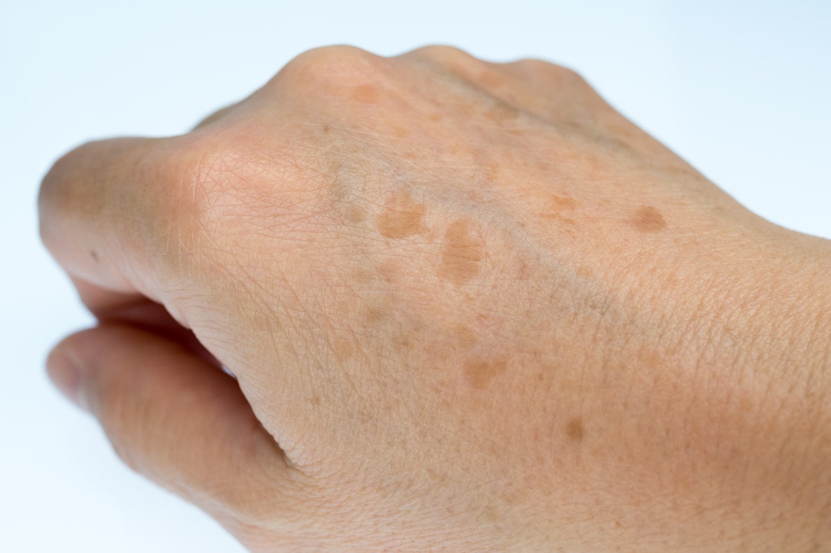 About Lupus Profundus