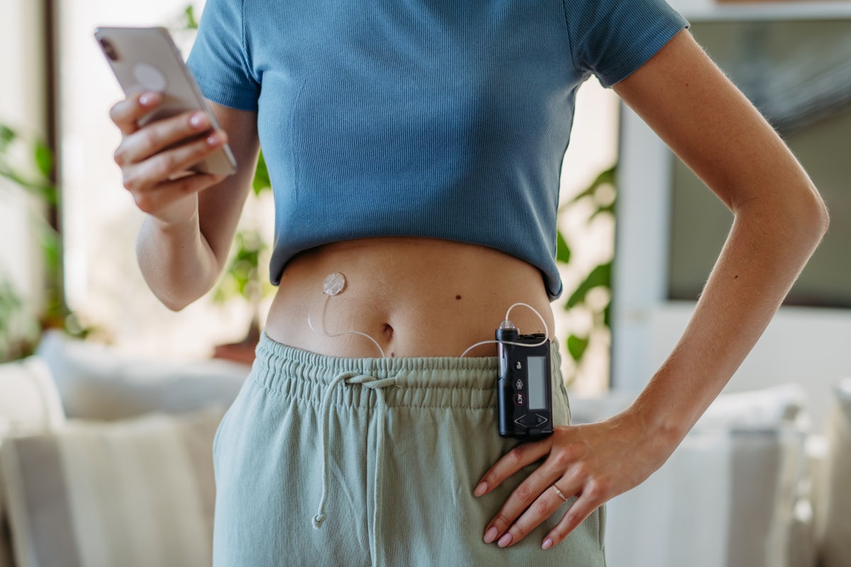 Transcutaneous Electrical Nerve Stimulation (TENs) for Interstitial ...