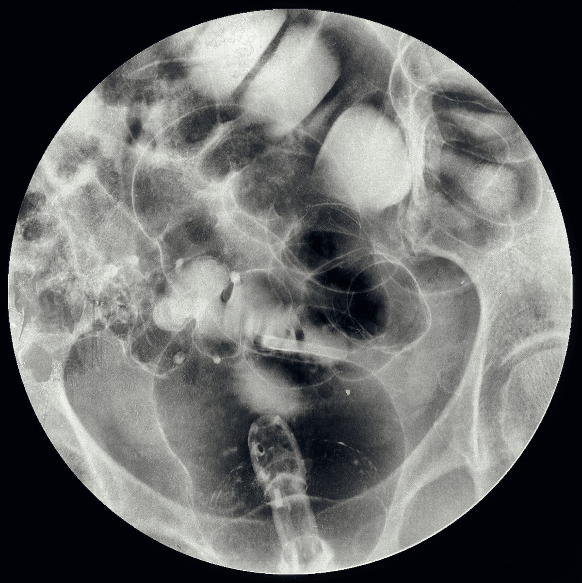 Diagnosing Bladder Calculi (Bladder Stones)