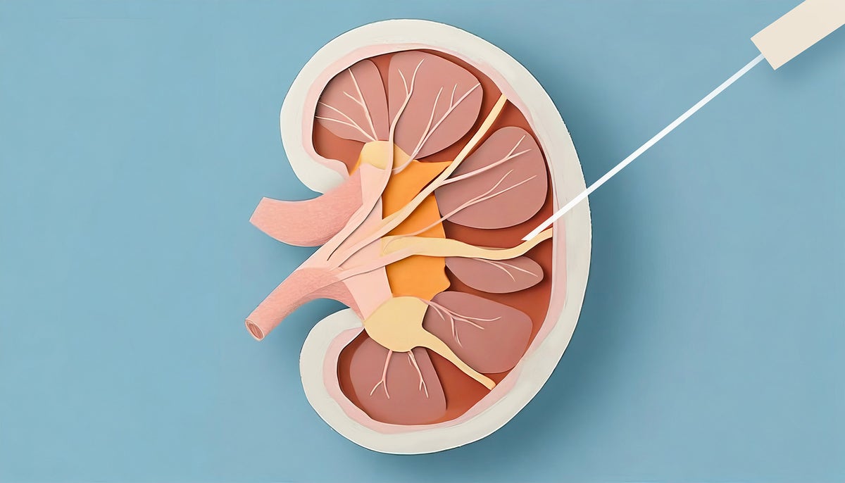 Surgery for Kidney Stone Removal