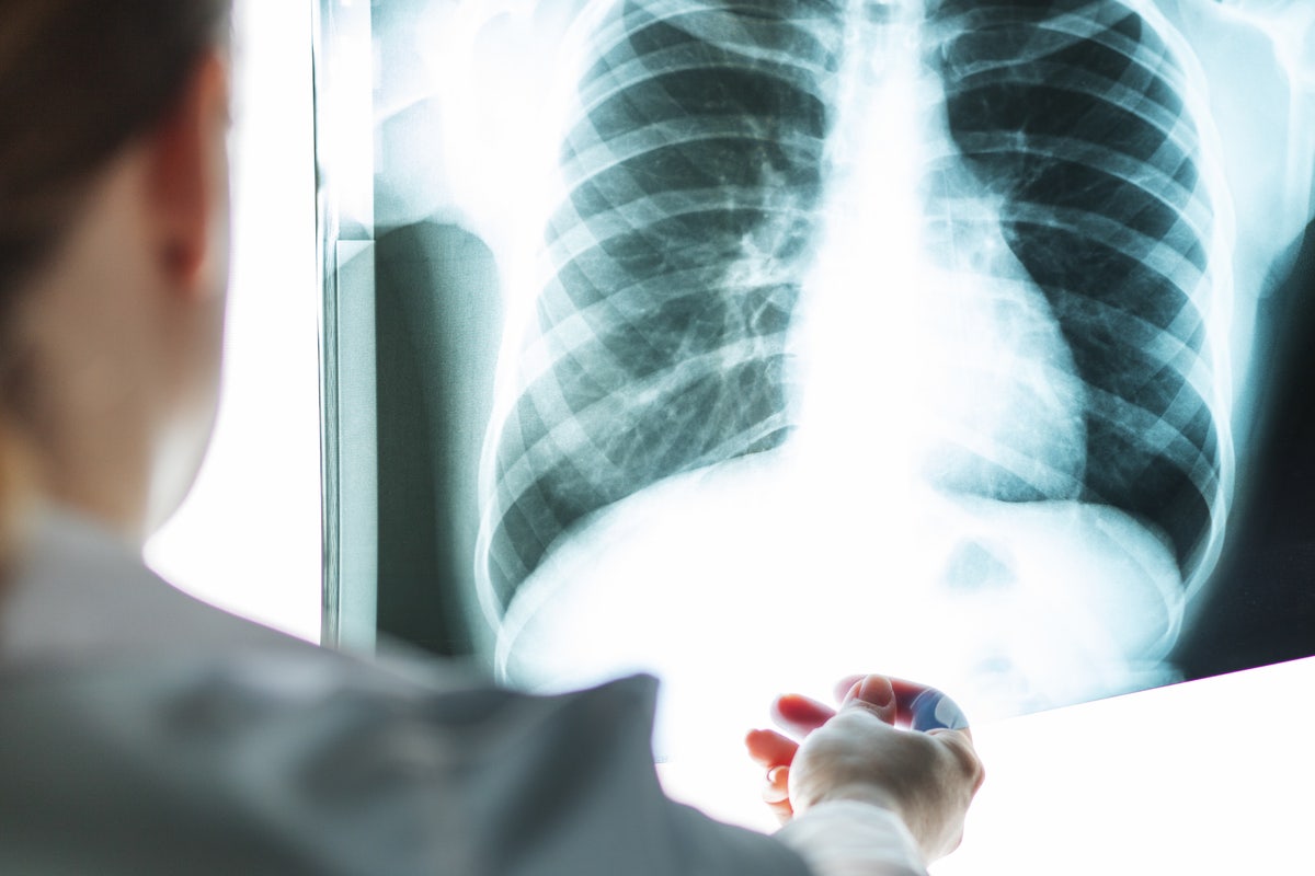 Hyperinflated Lungs and COPD