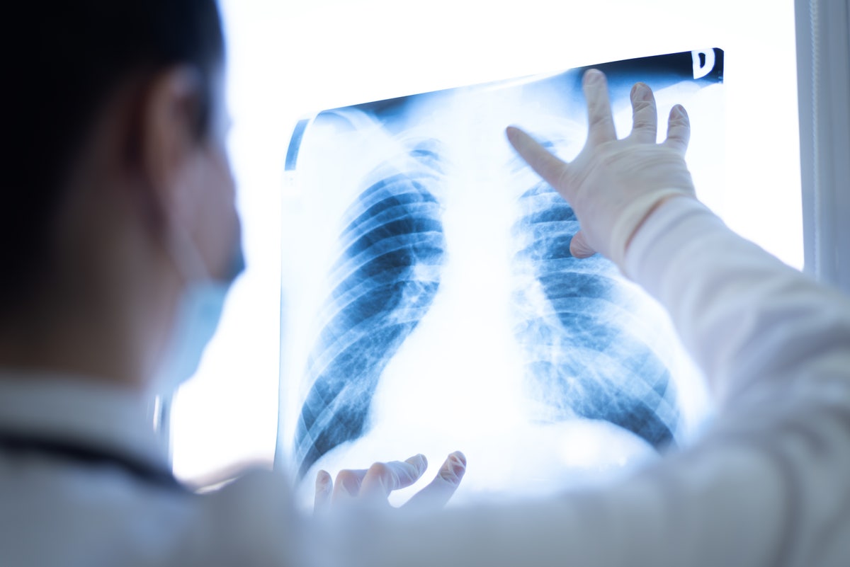 About Septic Pneumonia