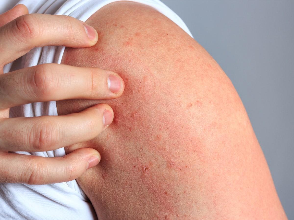 About Itchy Skin (Pruritus)